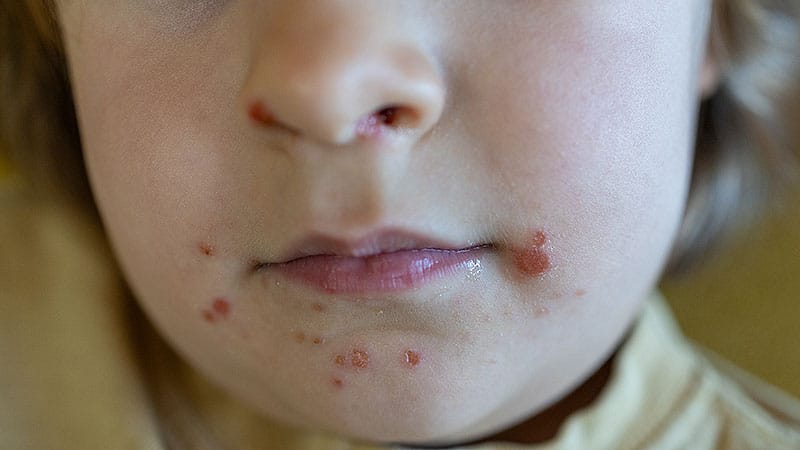 Pediatric IBD: Combined Tx Affects Skin Infection Risk