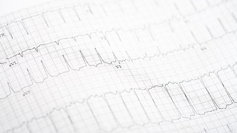 Atrial Fibrillation | Medscape