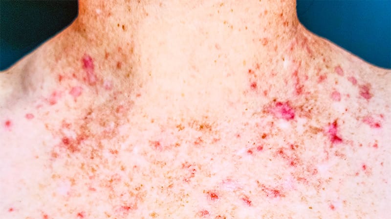 Amivantamab Tied to Diverse Dermatologic Events in NSCLC