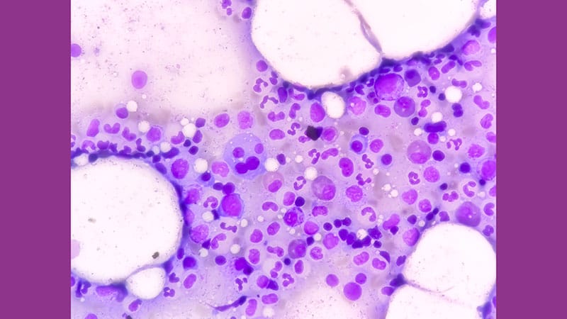 Multiple Myeloma | Medscape