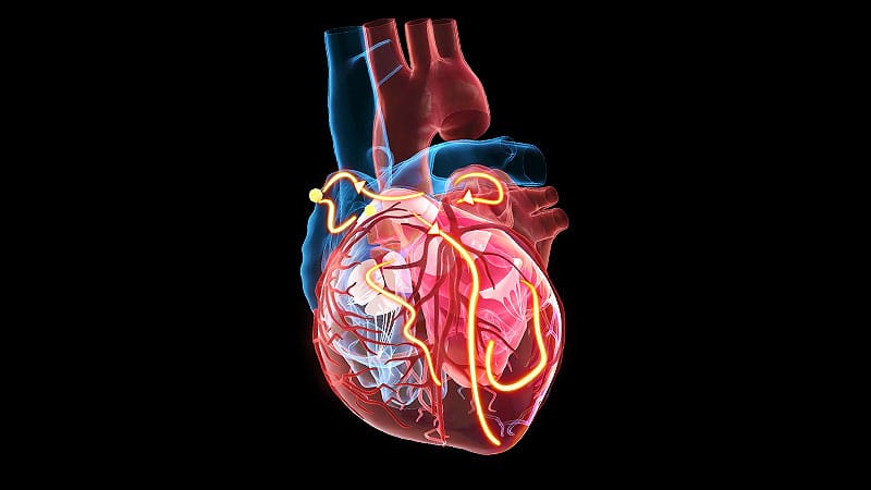 Loop Recorders Reveal Arrhythmias in Cardiac Amyloidosis