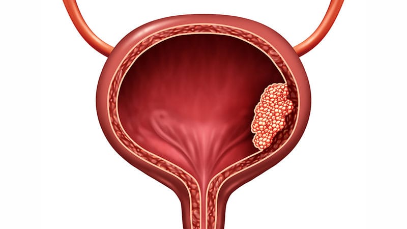 Durvalumab Plus BCG Earns FDA Nod for Bladder Cancer