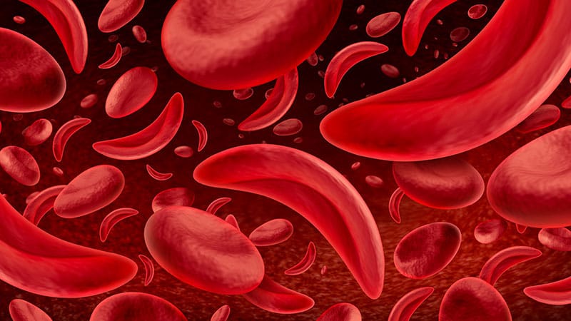 The Evolving Landscape of Sickle Cell Disease Treatment