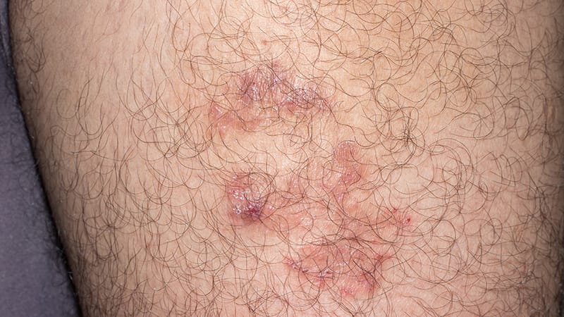 Pemphigus: Rituximab Shows Lower Cancer Risk Than Other Txs