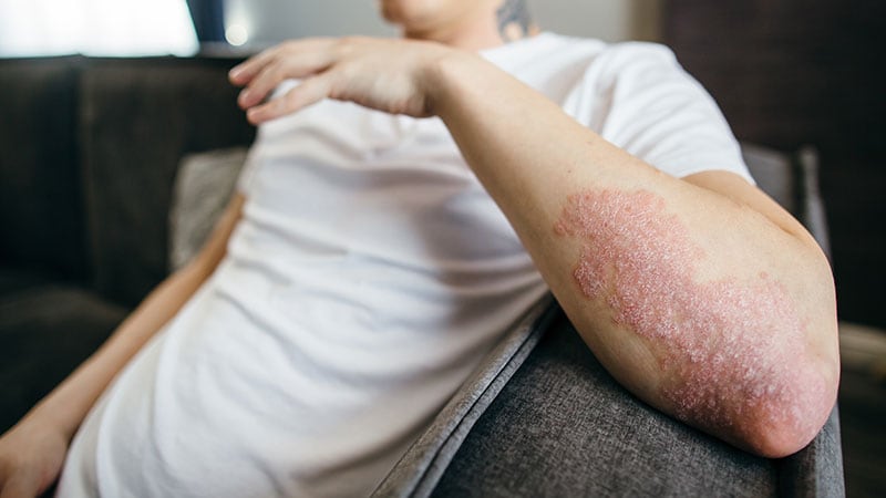 Biologics Effective Against Photosensitive Skin Diseases