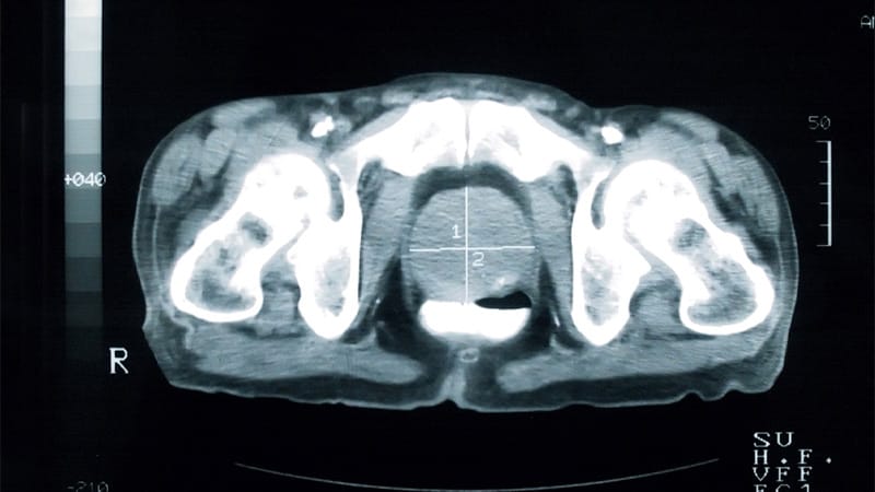 Water Ablation Shows Early Promise for Prostate Cancer
