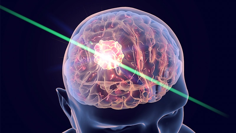 NHS Rolls Out 'Pioneering' Laser Therapy for Epilepsy