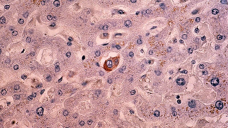 DRESS-Syndrom: Seltene Arzneimittelreaktion bei Colitis ulcerosa