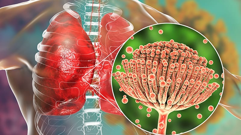 ELISA Test Fares Best for Identifying ABPA