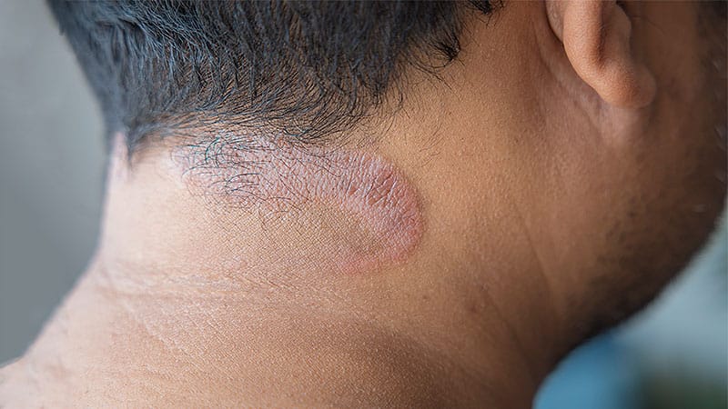 FDA Approves New Topical for Atopic Dermatitis