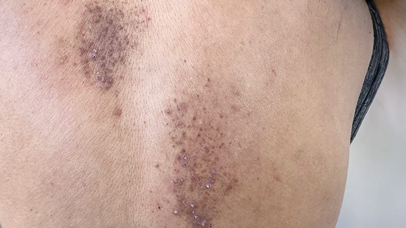 Atopic Dermatitis | Medscape