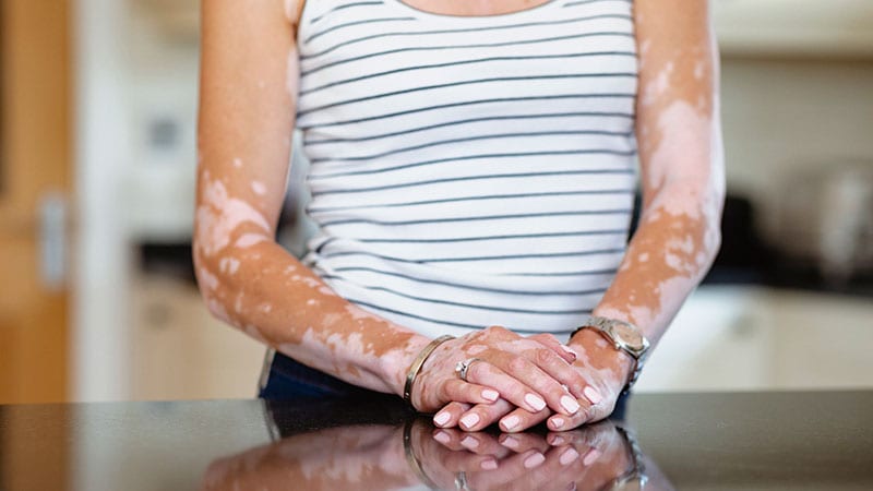 Skin Cancer Risk Found Lower for Those With Vitiligo