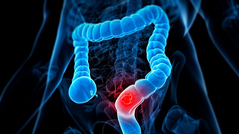 New Analysis Establishes Cure Definition for Colon Cancer