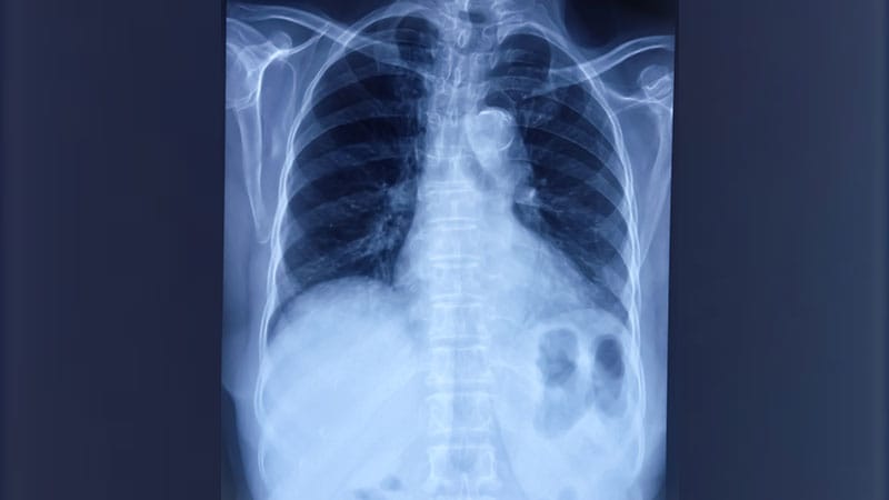 Pneumonia | Medscape