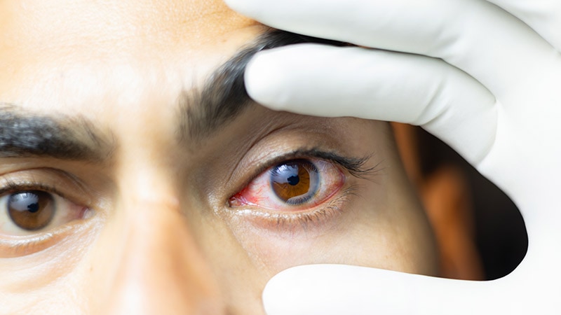 Warning Over Ocular Injury From Epimax Ointments
