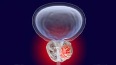 Simple Score Helps Predict Prostate Cancer Survival Outcomes