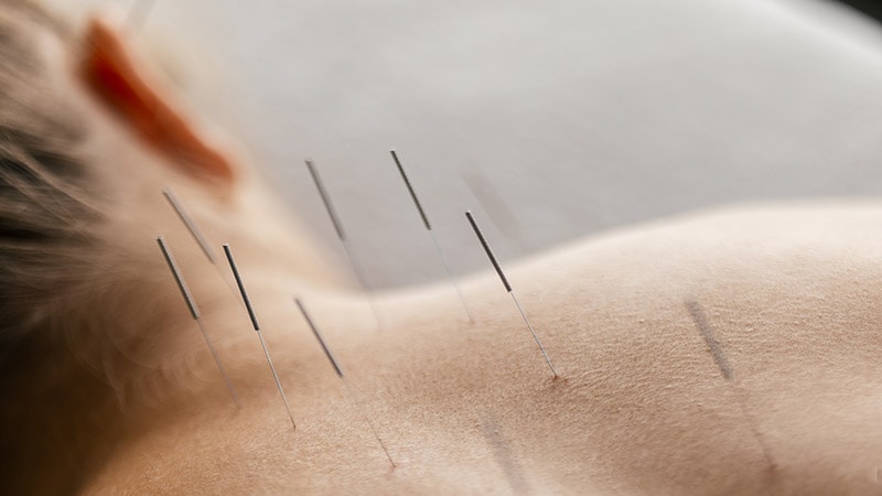 Acupuncture Eases Chronic Low Back Pain, Boosts Function