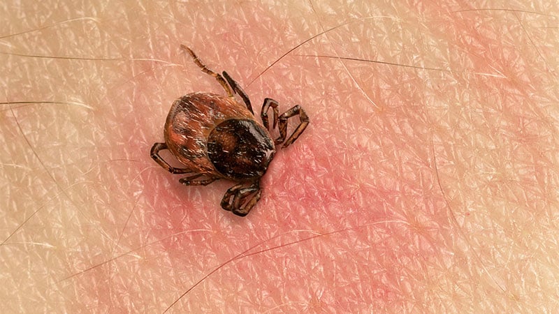 New Lyme Blood Test Bests Standard Diagnostics