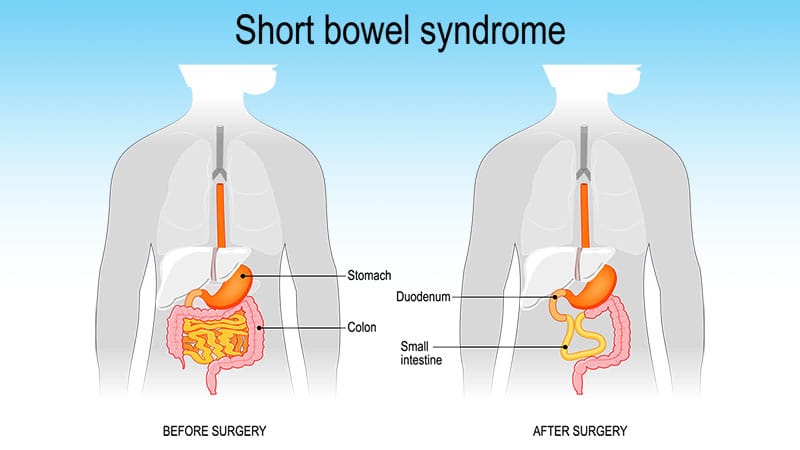 Short-Bowel Syndrome Treatment Nears Approval in EU