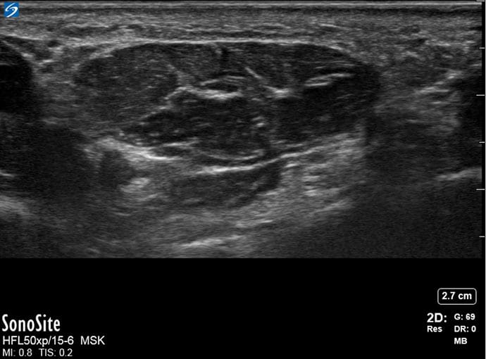 Chronic Foot Pain