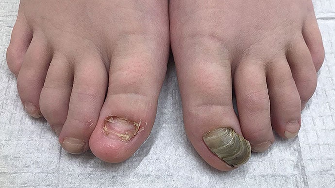 Athlete's Puzzling Toe Ailment
