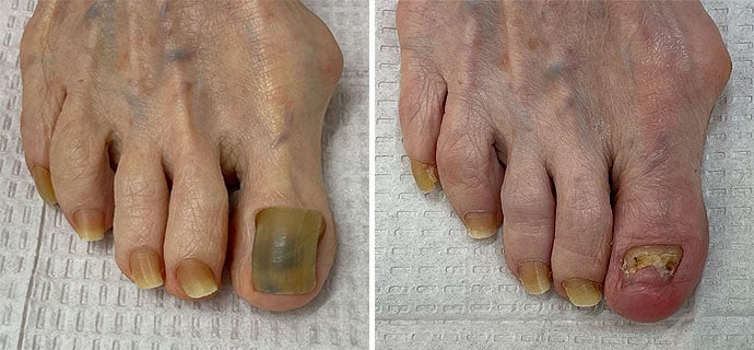 Athlete's Puzzling Toe Ailment