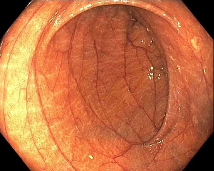 A 67-Year-Old Woman With an Incidental Rectal Mass
