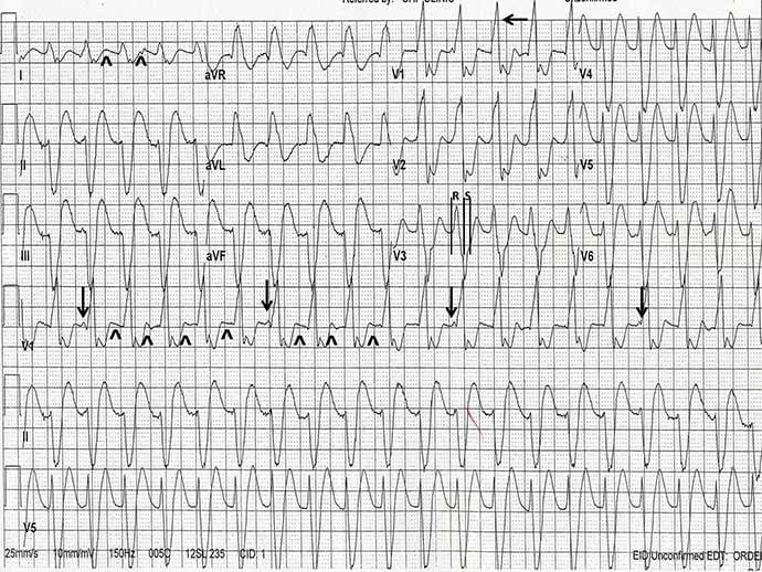 ECG Challenge: Heart Patient With a Racing Pulse
