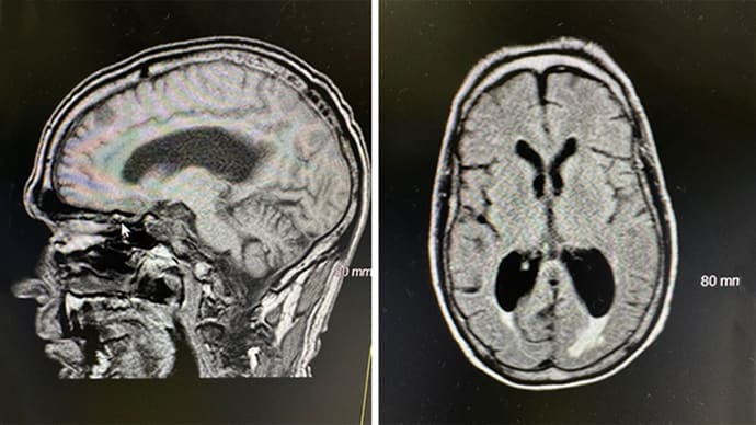 Weight Loss, Insomnia, and Cognitive Decline in His 50s