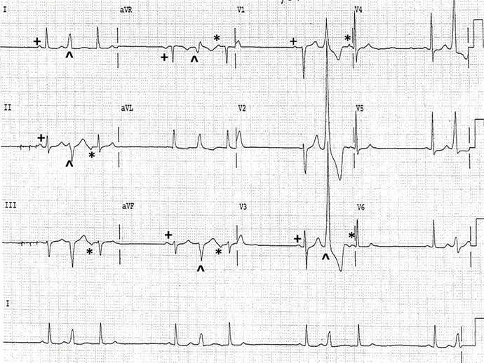 ECG Challenge: Cardiomyopathy and an Irregular Rhythm