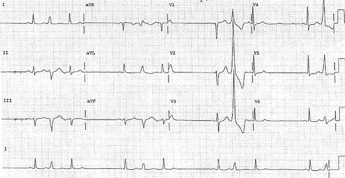 ECG Challenge: Cardiomyopathy and an Irregular Rhythm