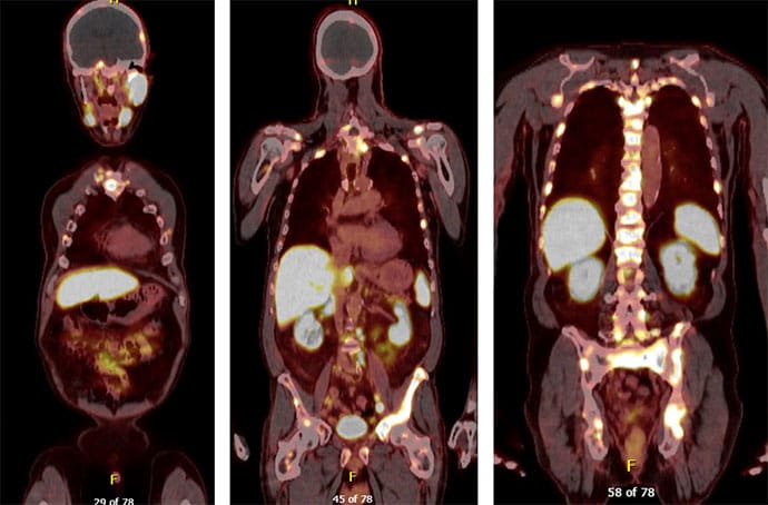 Unremitting Lumbar Pain in a 65-Year-Old Man
