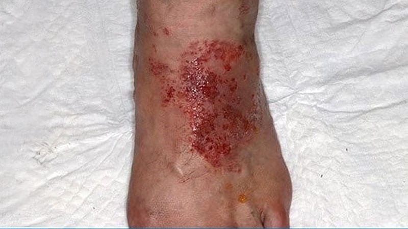 Hiker With Worsening Foot Rash