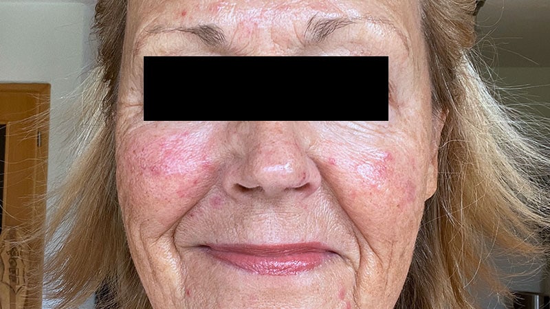 Rosacea Treatment: Filling in the Gaps