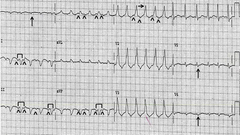 ECG : tachycardie après un pontage aorto-coronaire