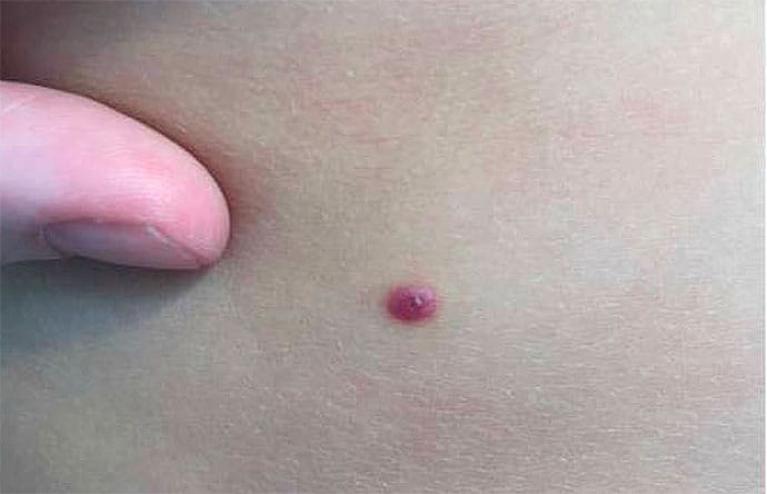 A 2-Year-Old Girl With a Single Pink 'Bump' on Her Abdomen
