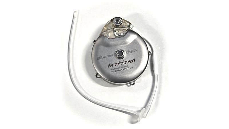 Intraperitoneal Insulin an Option for Select T1D Patients