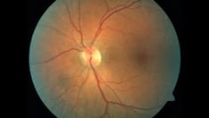 Vision May Worsen Soon After Optic Nerve Stroke