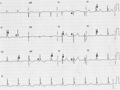 ECG Challenge: Feeling Cold and Confused