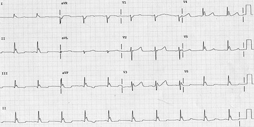 ECG Challenge: Feeling Cold and Confused