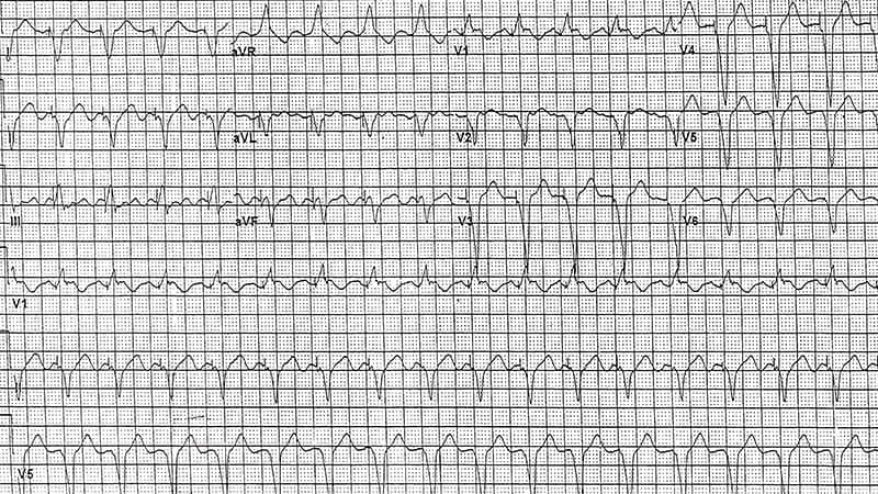 ECG Challenge: Possible Problems With a Pacemaker