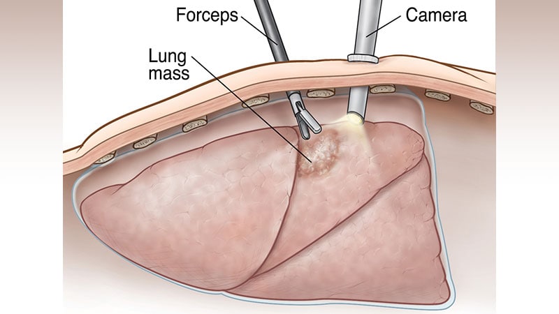 Lung Cancer Death Risk Reduced With VATS Over Open Surgery