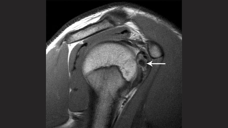 MRI Abnormalities Common in Pain-Free Shoulders