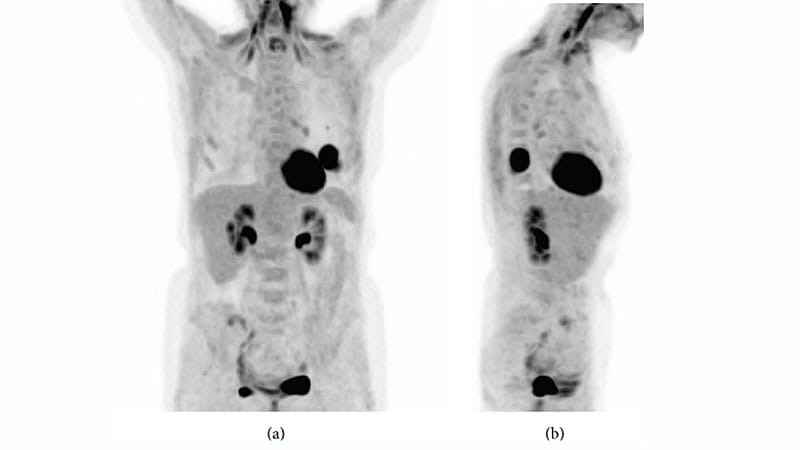 CCL19 as a Biomarker May Track IgG4-Related Disease Activity