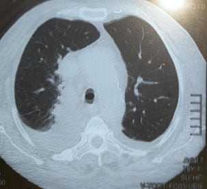 Anemia in a Heavy Smoker