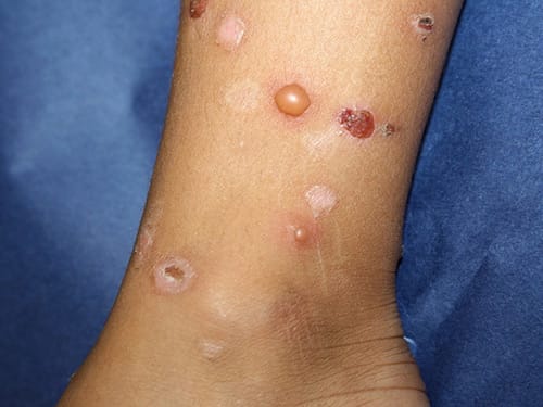 A 10-Year-Old Presents With ‘Itchy Bumps’ on His Extremities