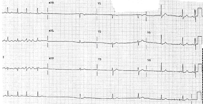 ECG Challenge: On-Again, Off-Again Lightheadedness