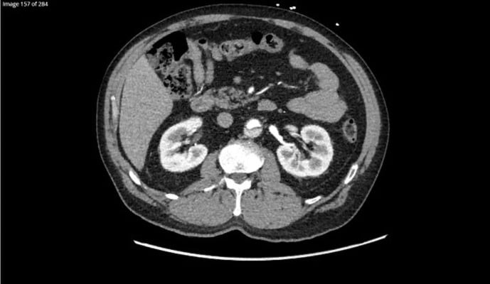 Acute Right Upper Quadrant Pain