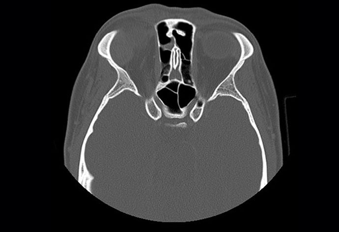 A 20-Year-Old Woman With Periorbital Swelling
