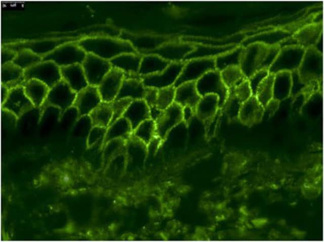 Unresolved Rash in a 44-Year-Old Woman with Crohn’s Disease